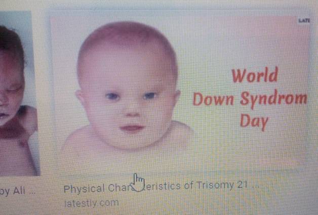 Facts about down syndrome -"Trisomy 21"